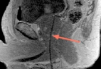 MRI Focal Laser Ablation - Scionti Prostate Center