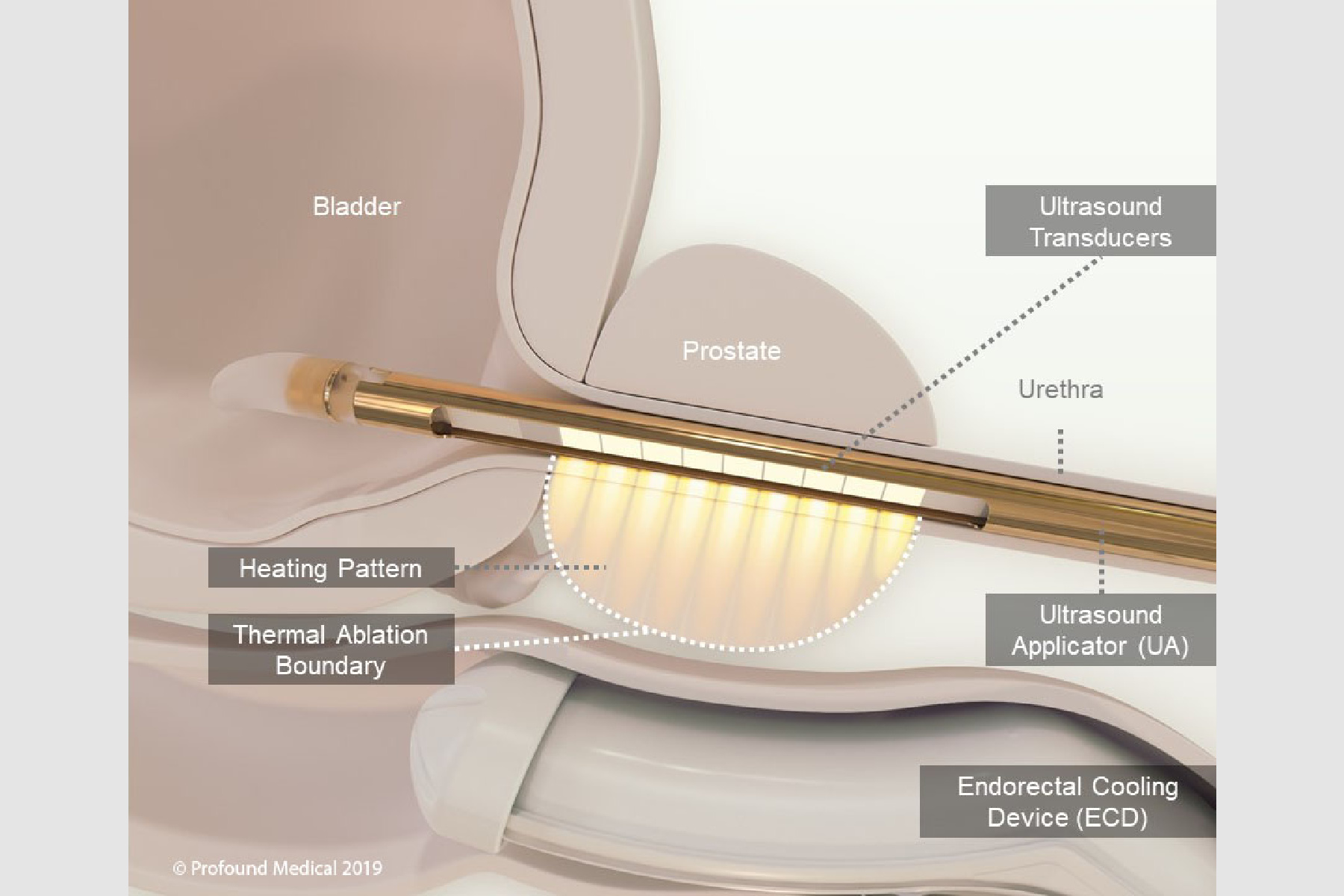Tulsa Pro Prostate Cancer Treatment