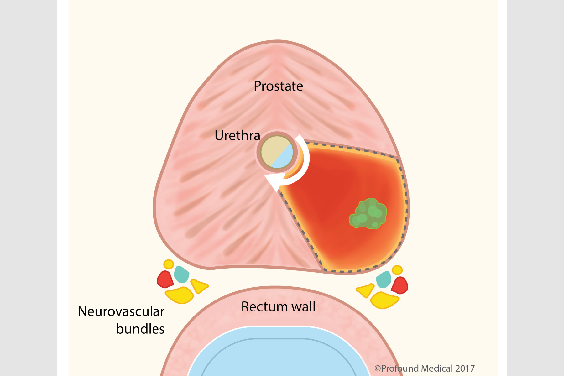 Tulsa Pro Prostate Cancer Treatment