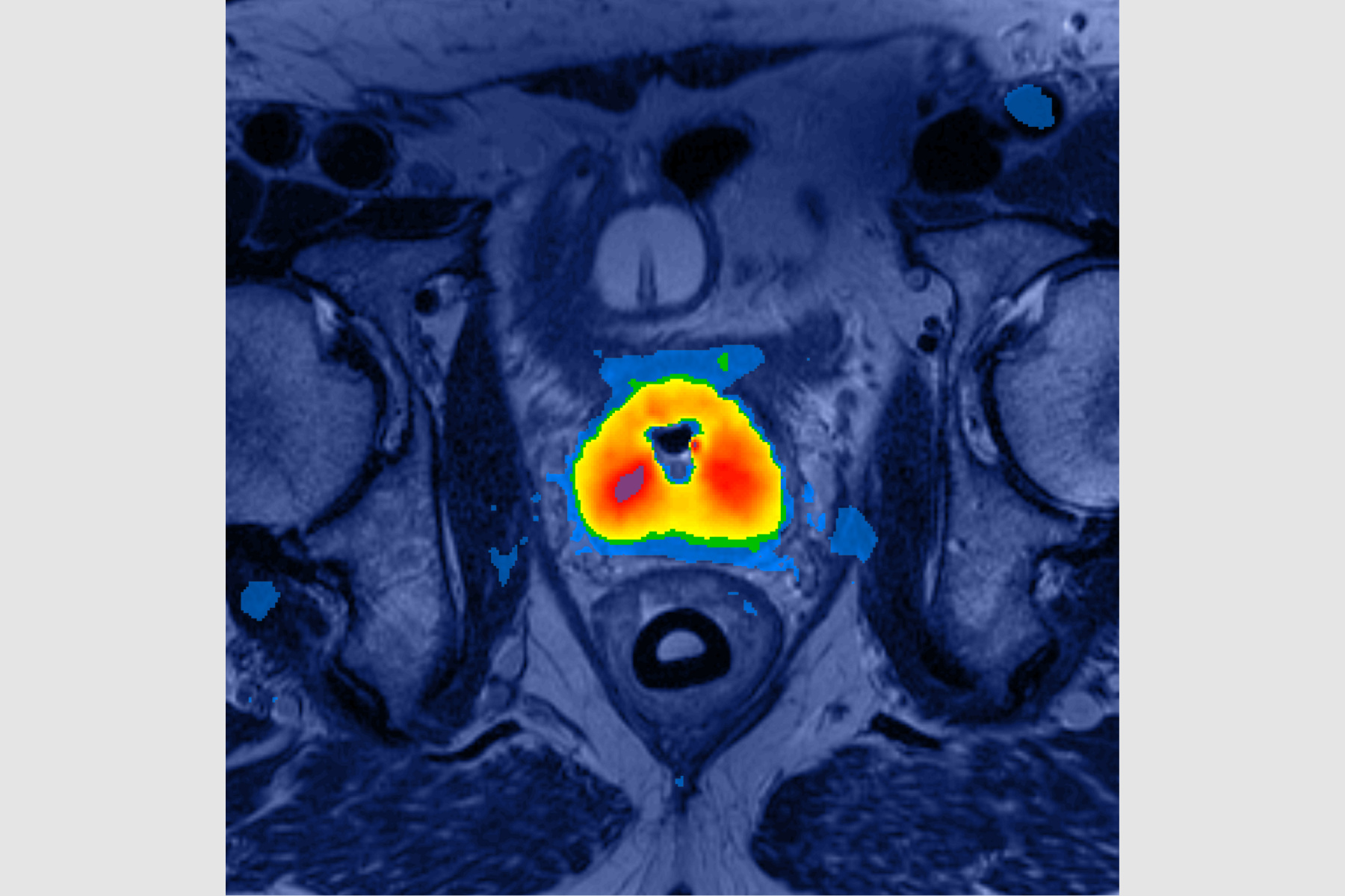 Tulsa Pro Prostate Cancer Treatment